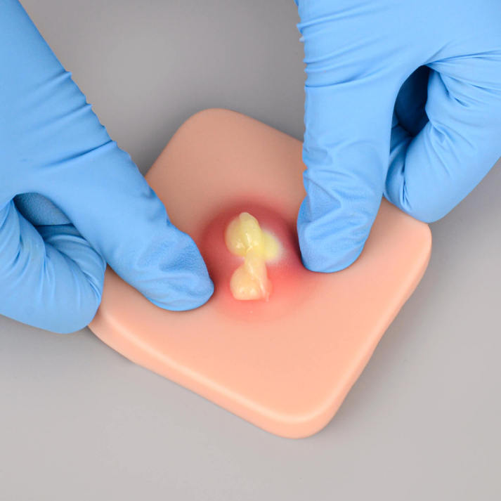 Ultrassist Abscess I&D Incision and Drainage Trainer (6-Pack Pad)