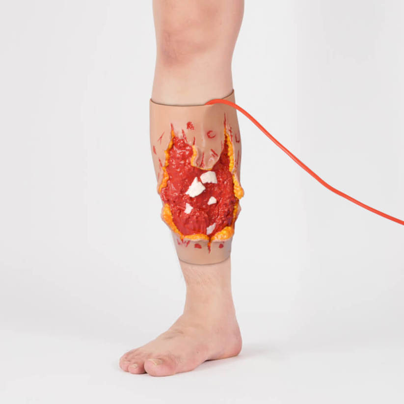 Trauma Blast Injury Wound Sleeve with Open Fracture – Ultrassist