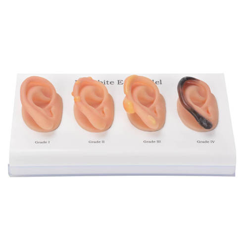 Ear Frostbite Model (Grades I–IV) with Display Stand – Ultrassist