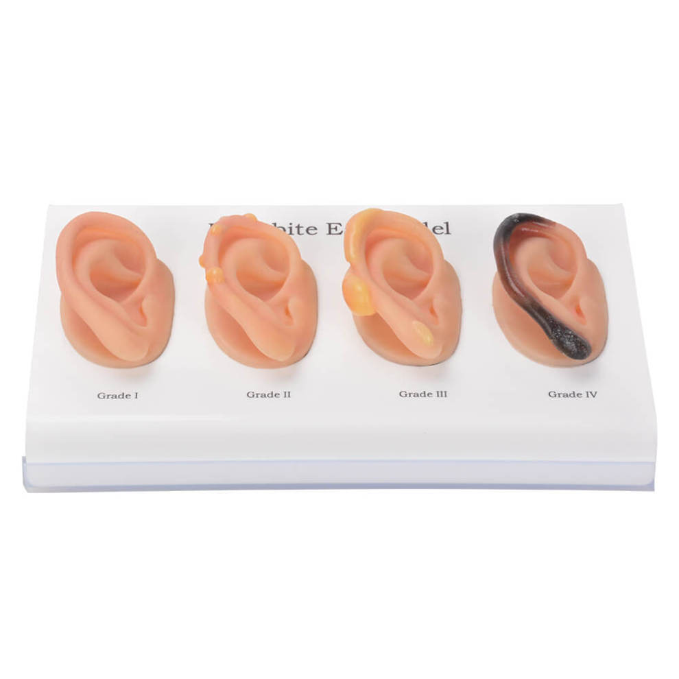 Ear Frostbite Model (Grades I–IV) with Display Stand – Ultrassist