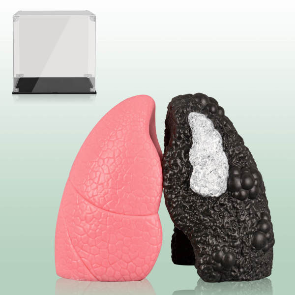 Ultrassist Healthy Lung vs. Smokers Lung Model Set