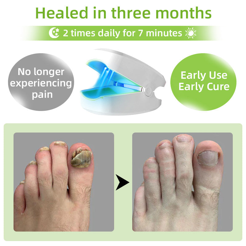 Laser nail fungus treatment device Furzero™ Max Plus