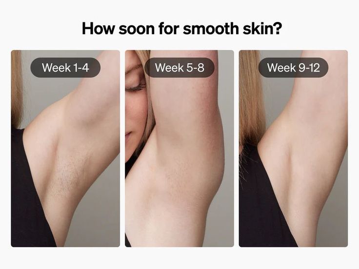 IPL Hair Removal Devices: How They Deliver Smooth, Hair-Free Skin at H ...
