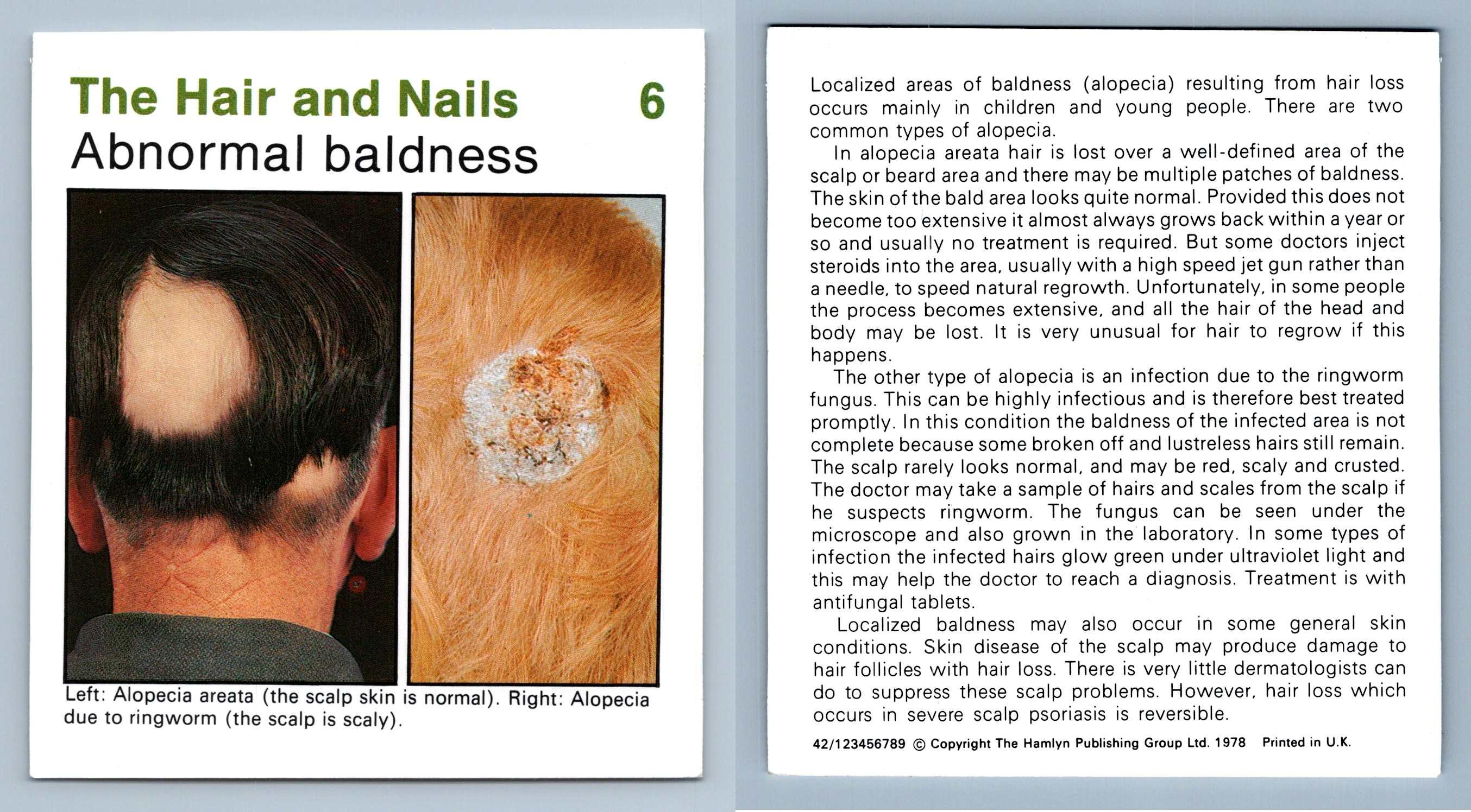Abnormal Baldness #6 Hair & Nails Home Medical Guide 1975-8 Hamlyn Car ...