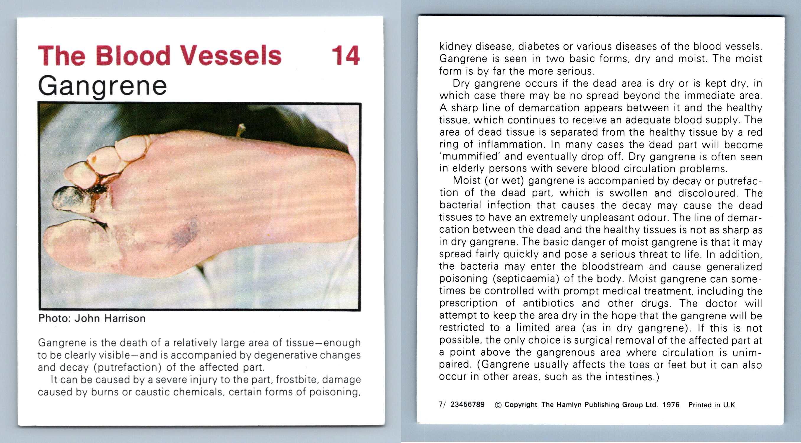 Gangrene #14 Blood Vessels - Home Medical Guide 1975-8 Hamlyn Card ...