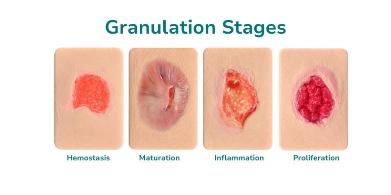 granulation wound picture
