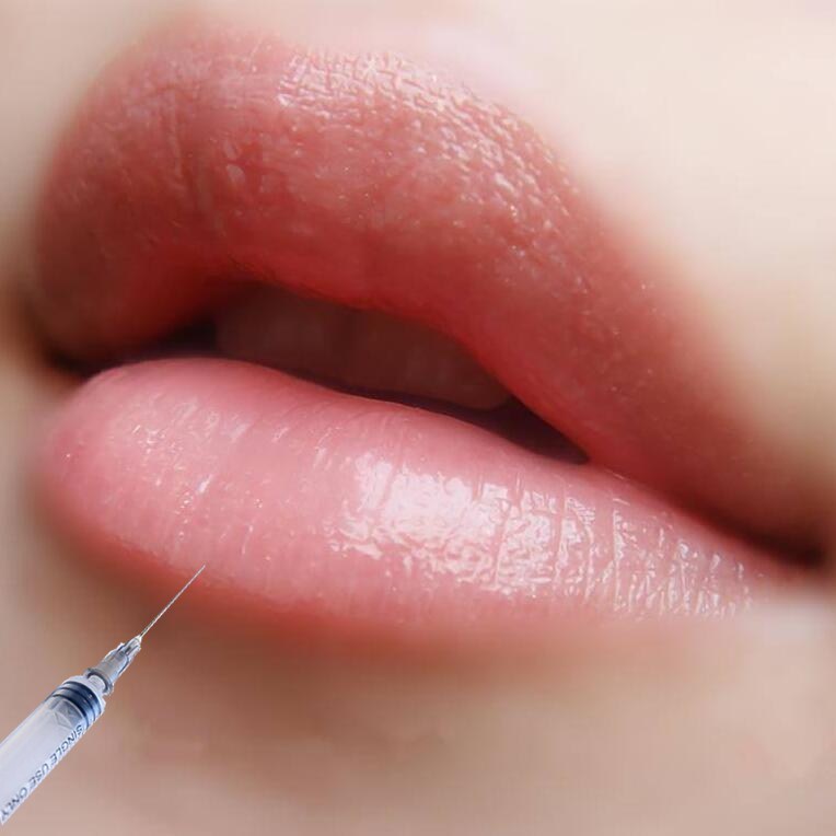 Everything You Need to Know About Hyaluronic Acid Lip Fillers-iRENICE