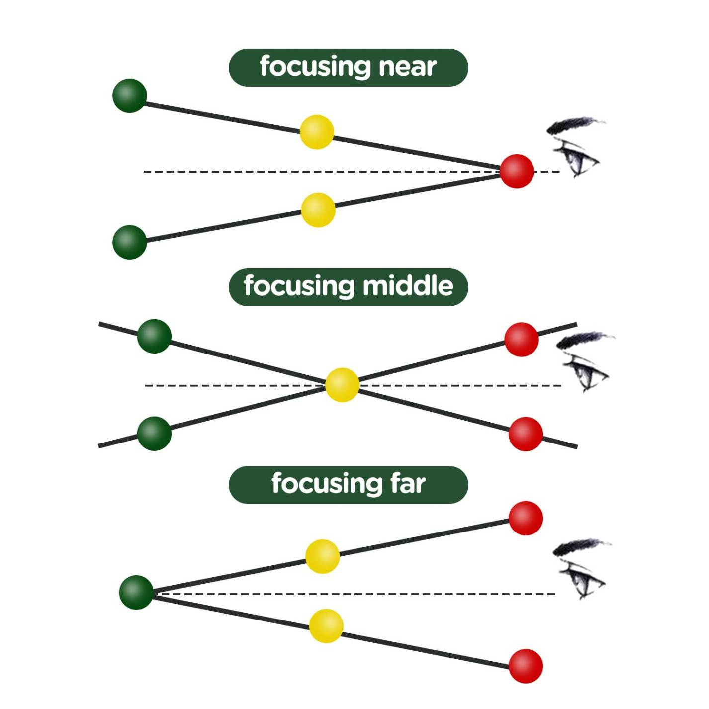 Ultrassist Block String for Vision Therapy, Convergence Training Tool
